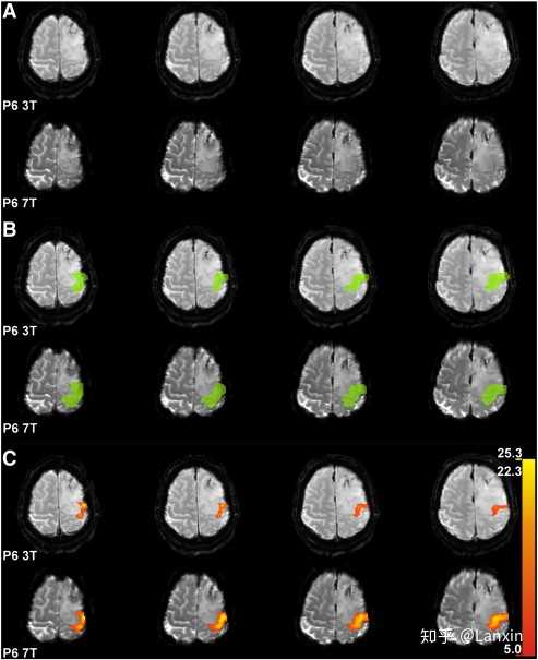 FMRI在1.5T,3T和7T的区别到底有多大？ - 知乎