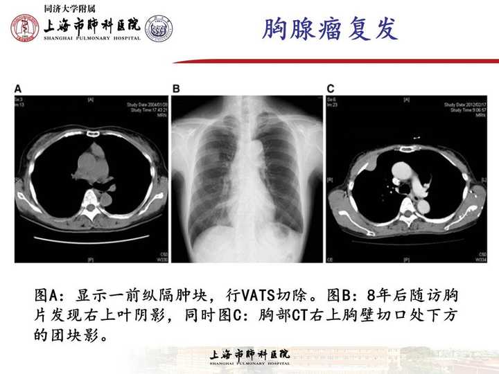 增强CT是否能判断胸腺瘤是良性还是恶性的？ - 知乎