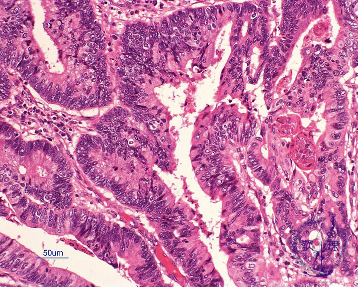按照AJCC胃癌分期标准，这个病理报告应该怎么分期，后续化疗用药搭配有什么建议方案？ - 知乎