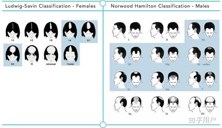 脱发n年了，这样子算几级脱发，还能恢复吗？ - 知乎