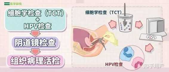 TCT和HPV检查都是什么，有什么区别呢？ - 知乎