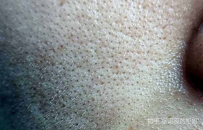 脸上有黑头怎么处理? 知乎