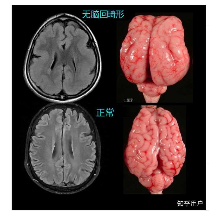大脑皮层都舒展开了，会发生什么？ - 知乎