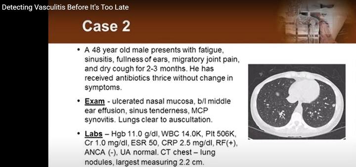 ANCA血管炎----记录父亲患病的经历 - 知乎