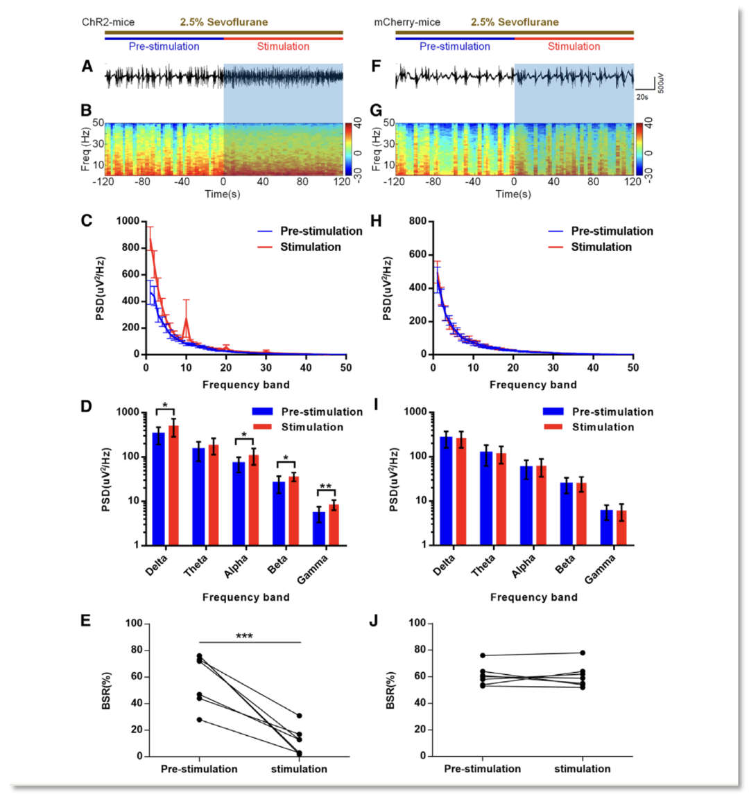 睡眠分析 | Lunion Stage® 功能更新：增加爆发抑制率指标计算功能 - 知乎