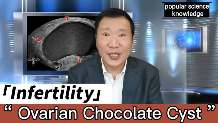 Chocolate Cysts:The Culprit Affecting Fertility - 知乎