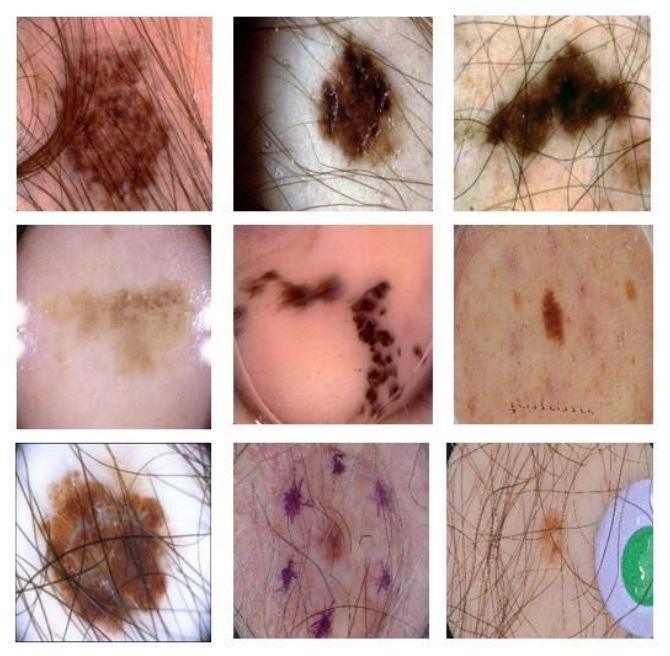 Lesion Net - Skin Lesion Segmentation Using Coordinate Convolution and ...