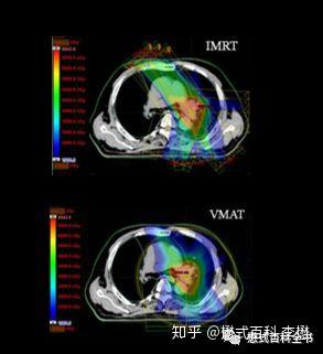 放射治疗基础知识 - 知乎
