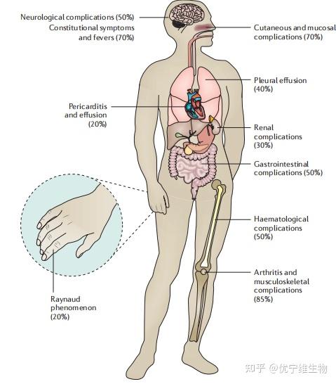 【优方案】SLE（系统性红斑狼疮）: Total Solution All in One - 知乎
