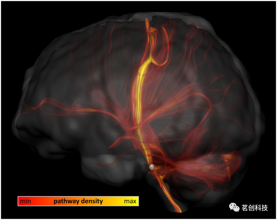 大脑弥散MRI纤维束成像 - 知乎