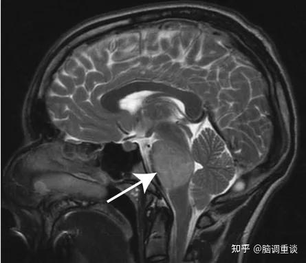 脑干胶质瘤DIPG治疗的新突破与未来展望 —— INC神外Rutka教授研究分享 - 知乎