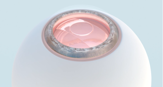 高度近视手术，PRL晶体植入术与ICL哪个更好？ - 知乎