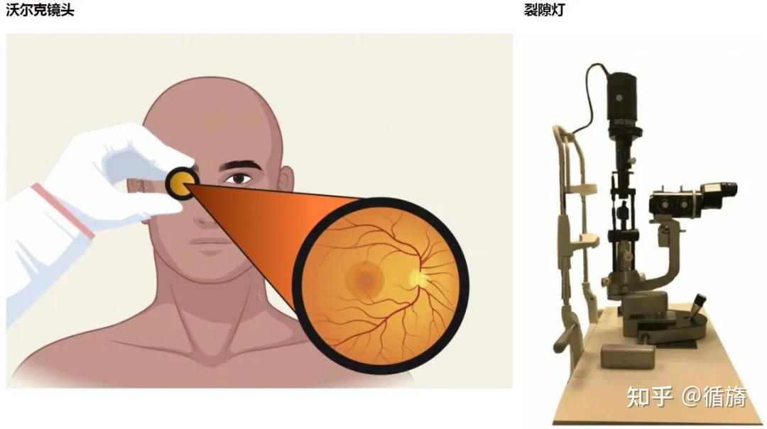 BEST1基因变异引起的黄斑营养不良征-卵黄蛋白病BVMD、AVMD、ARB、ADVIRC、RP - 知乎