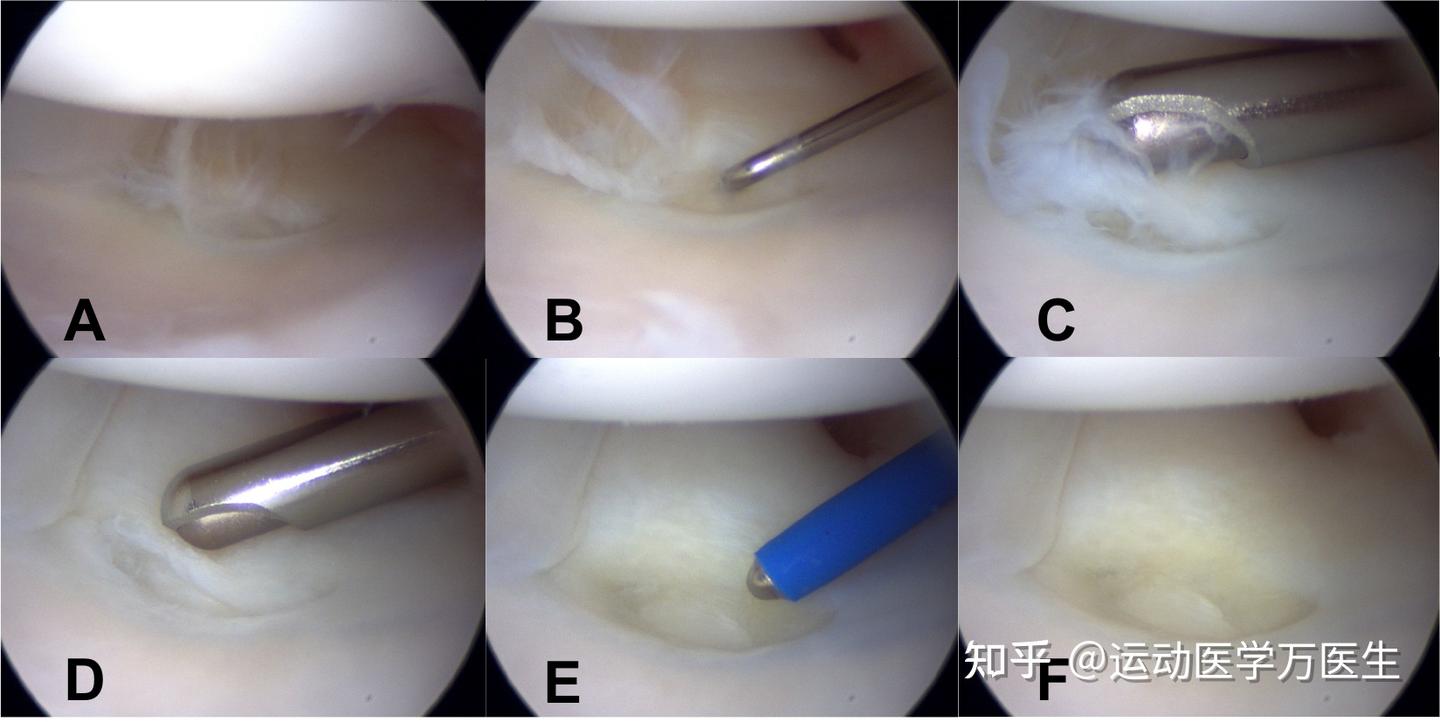 运动后手腕疼？可能里面的小软骨（TFCC）破了 - 知乎