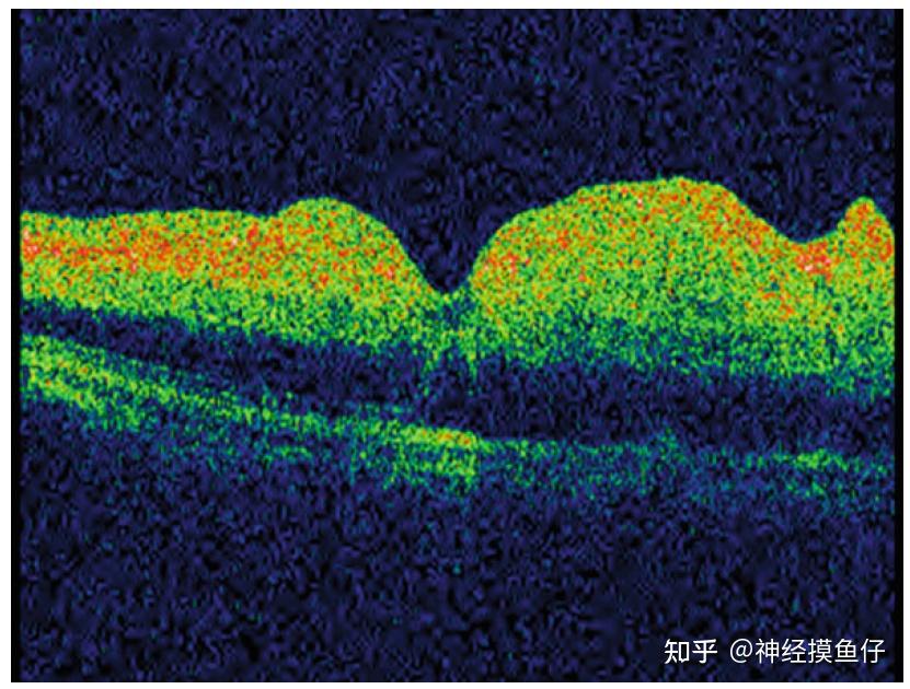 Chen et al. (2019) Retinal OCT Image Analysis 学习笔记 - 知乎