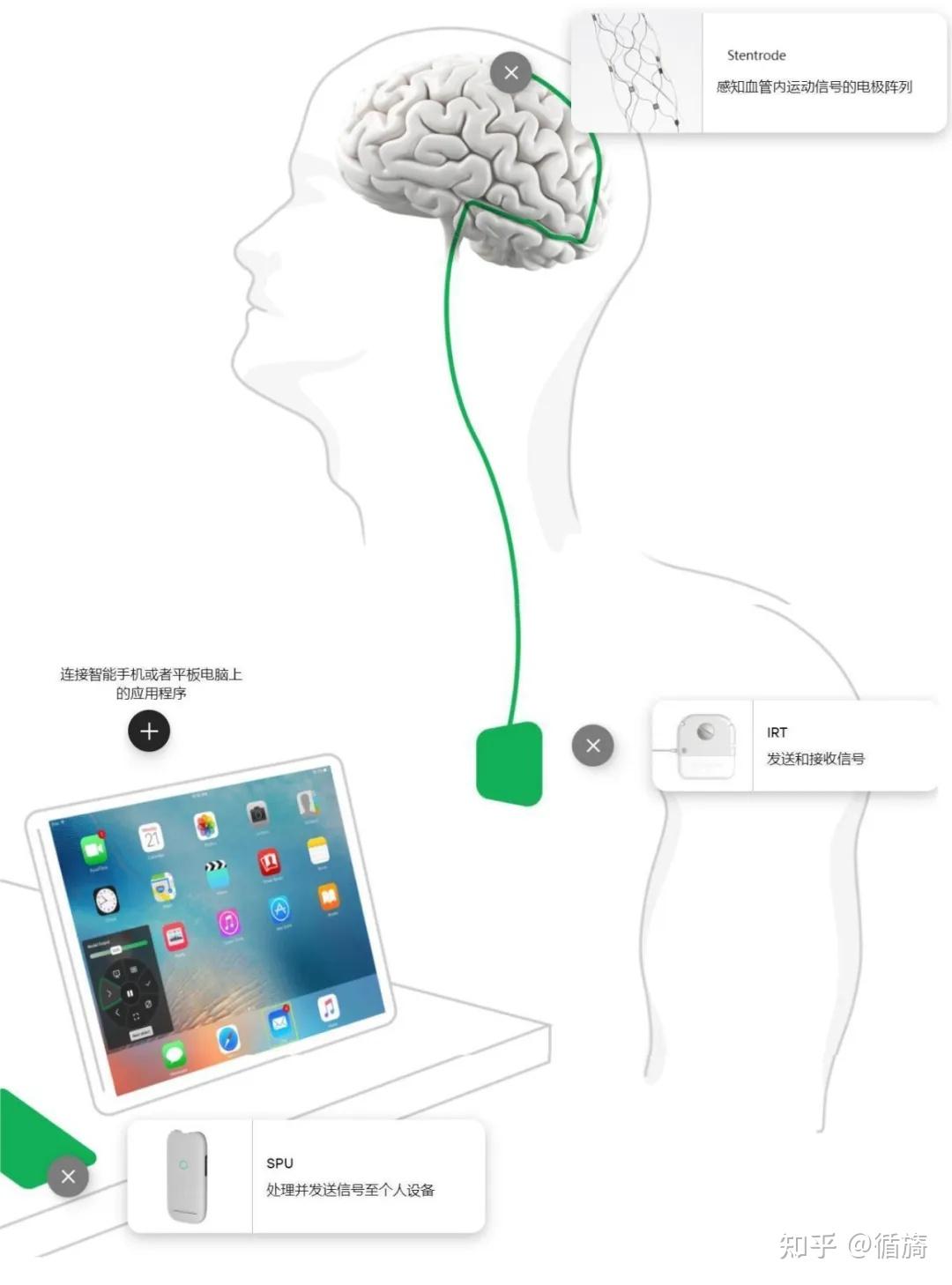 脑血管植入的脑机接口：Synchron公司的Stentrode - 知乎