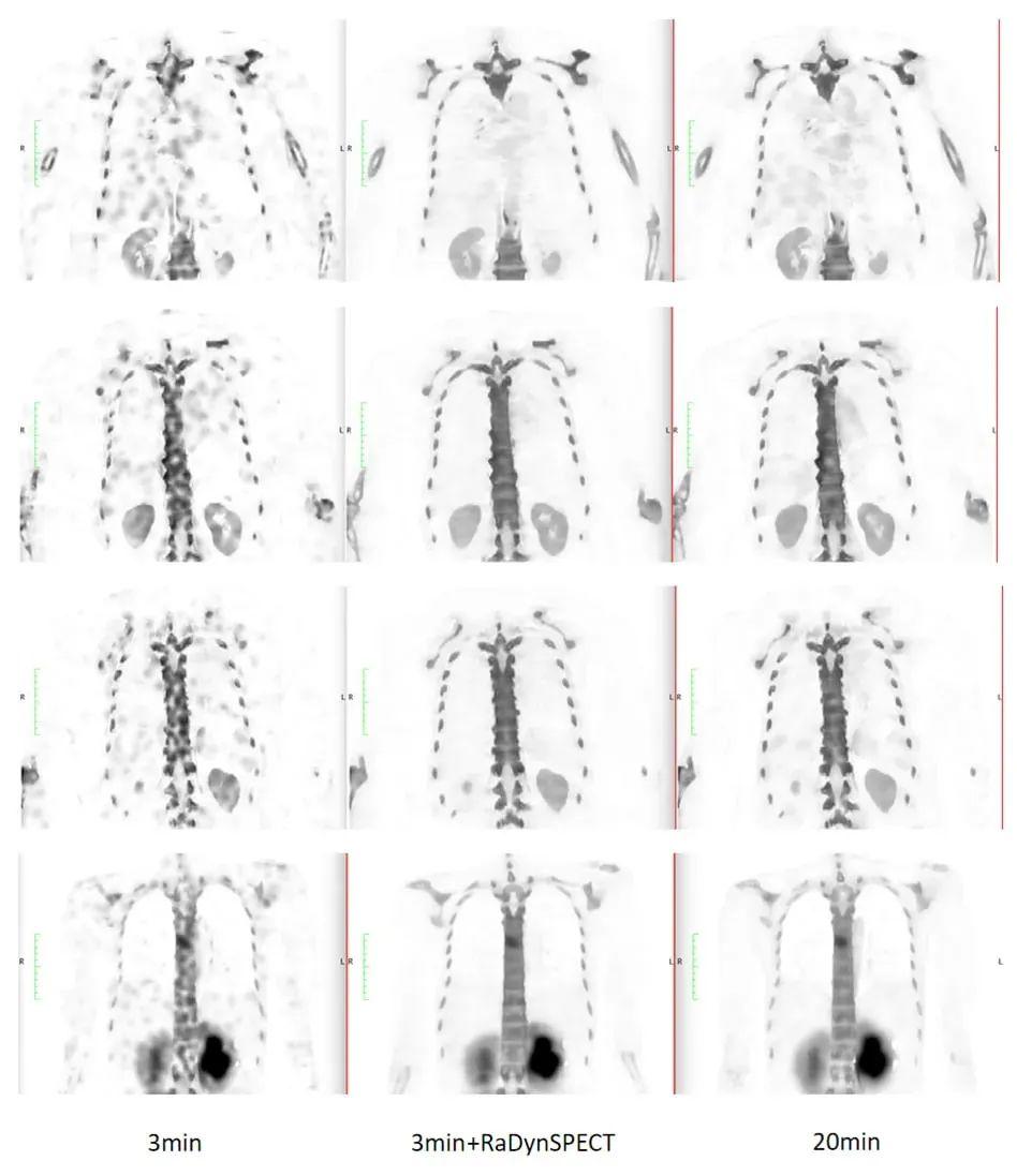 临床案例——RaDynMR、RaDynPET、RaDynCT、RaDynSPECT - 知乎
