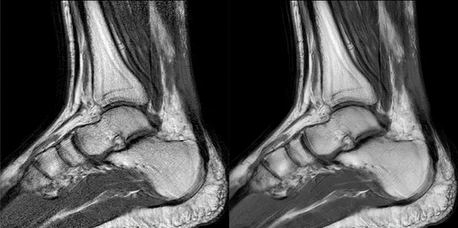 RaDynMR赋能踝关节扫描 - 知乎