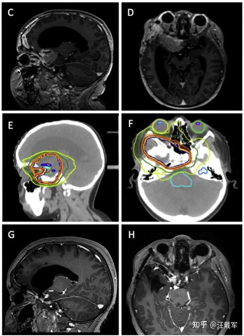 6岁间变脑膜瘤患者，诊断为MEN4综合征 - 知乎