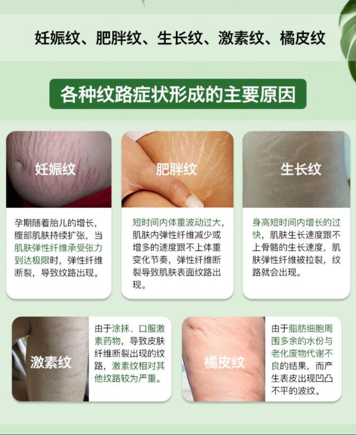 妊娠纹、肥胖纹、生长纹等,你中了哪一种 知乎