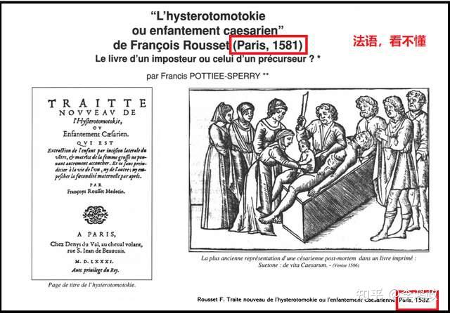 剖宫产，前世今生 - 知乎