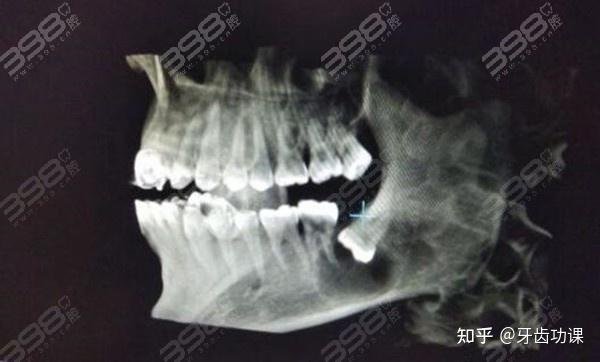 看最难拔的智齿图智齿拔除难度分级知横向阻生智齿多少钱 知乎