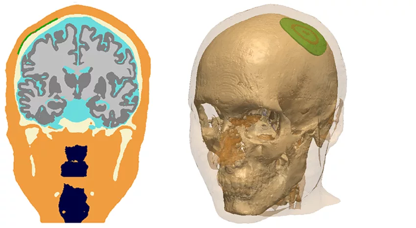 【Simpleware】通过新颖的颅外皮层刺激技术进行微创神经调节 - 知乎