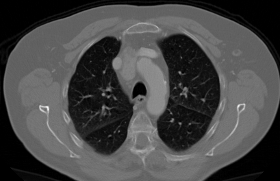 Chest CT-Scan images 数据集介绍 - 知乎