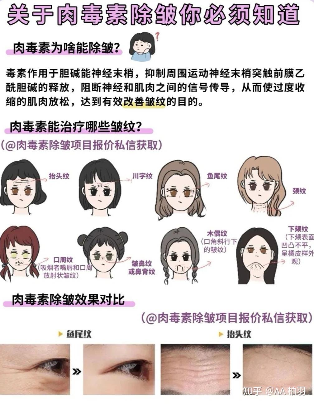 保妥适，衡力，吉适，乐提葆，这些品牌的肉毒毒素该怎么选？（附点位图和配比） - 知乎