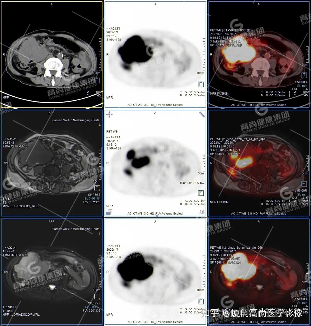 【高尚病例】PET/CT-MR 多模态融合技术在临床中的应用病例分享（一） - 知乎