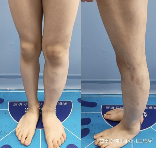 KT综合征(Klippel-Trenaunay syndrome，KTS) 介入治疗 - 知乎