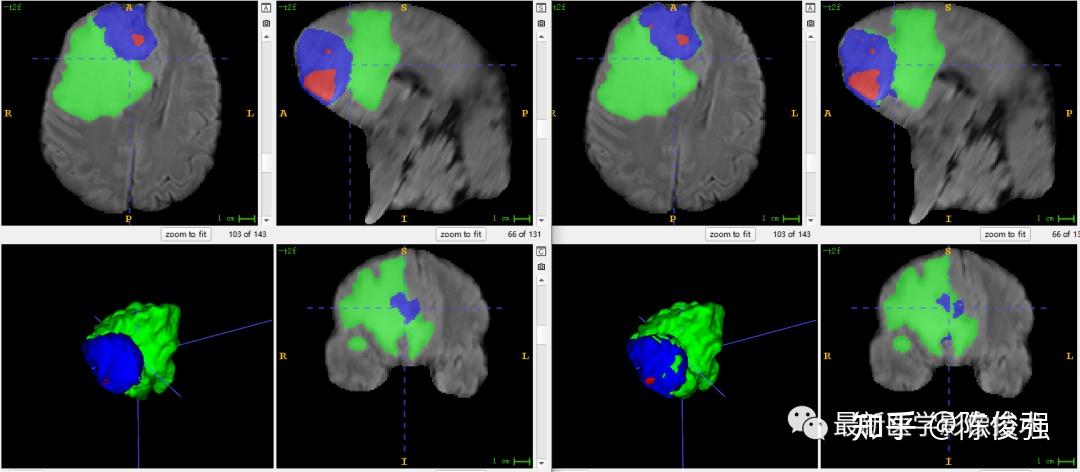 BraTS2023-MEN——BraTS2023颅内脑膜瘤分割挑战赛 - 知乎