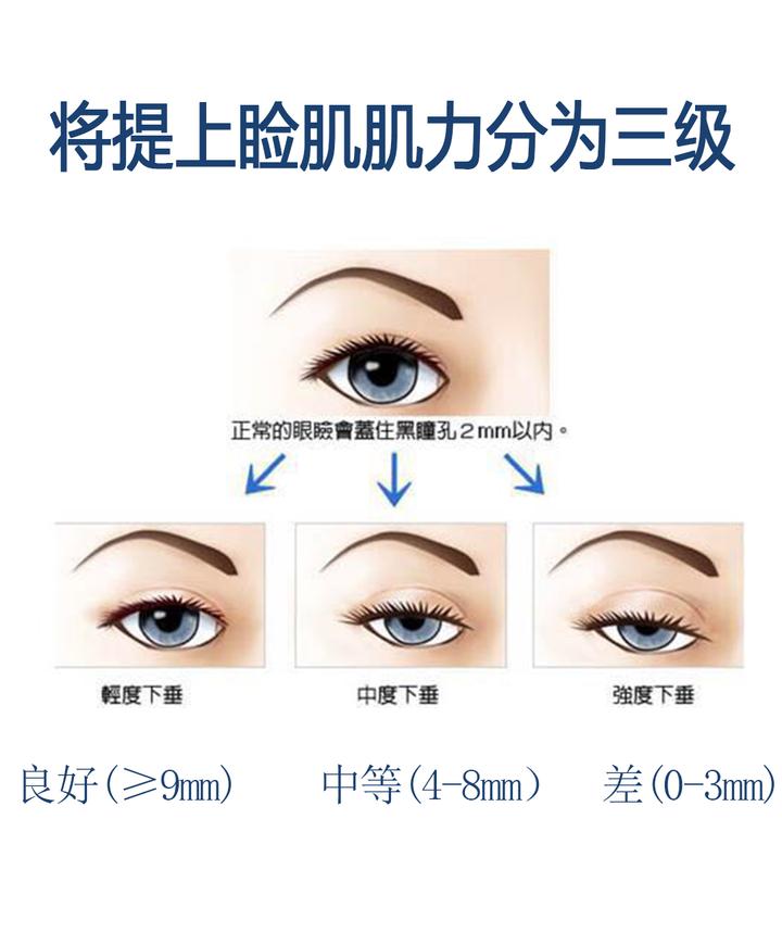 先天性上睑下垂——单纯性性上睑下垂 知乎