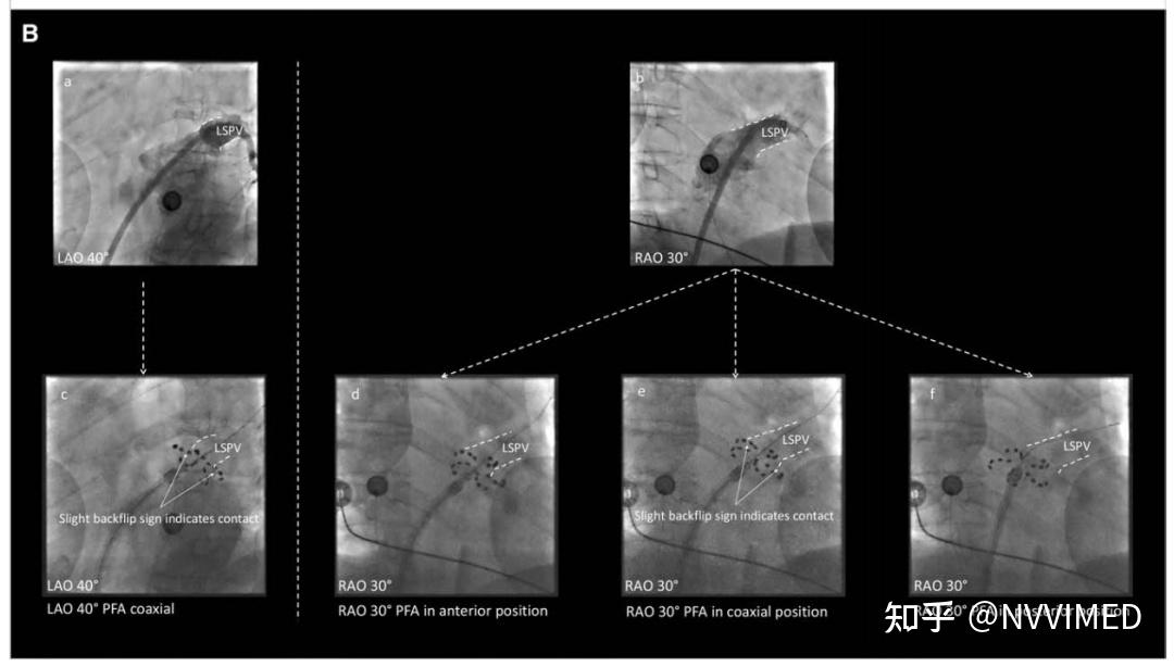 2025年房颤PFA脉冲场消融国际专家实践指南，详解PFA消融新流程！ - 知乎