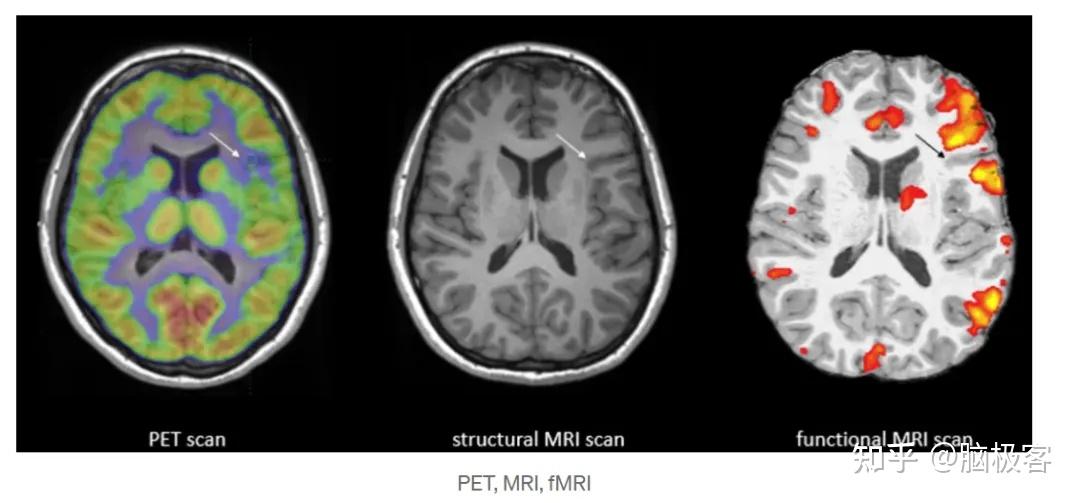 fMRI功能连接及其分析方法简要概述 - 知乎