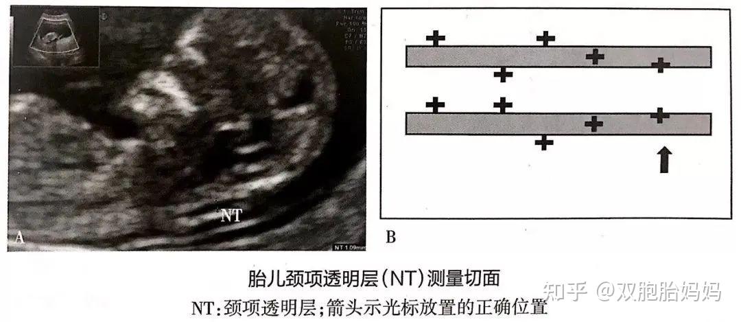 掌握基本功！一看就懂的NT测量常用解读方法，图文并茂 - 知乎