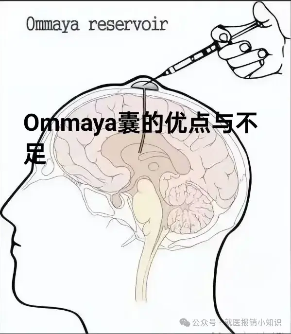 Ommaya囊植入的优点与不足 - 知乎