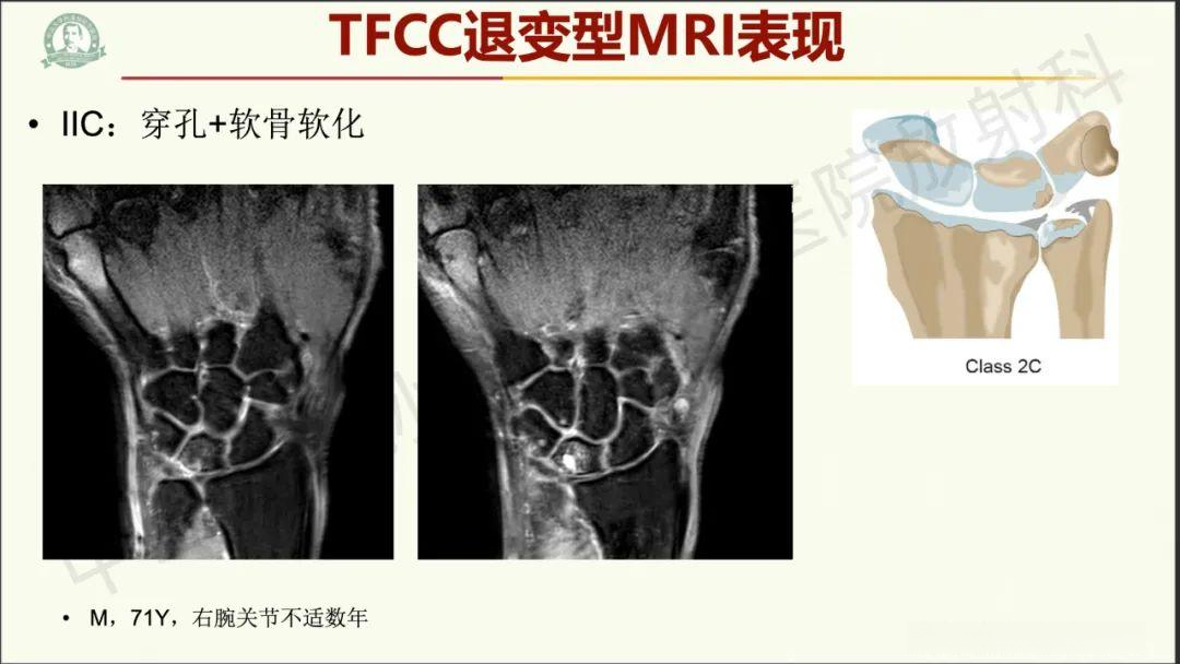 TFCC损伤MRI诊断 - 知乎
