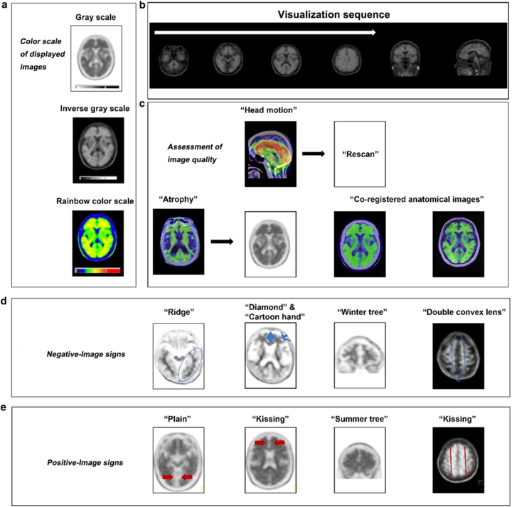 Phenomics| 我国科学家发布阿尔茨海默病淀粉样蛋白PET分子影像临床应用国际专家共识 - 知乎