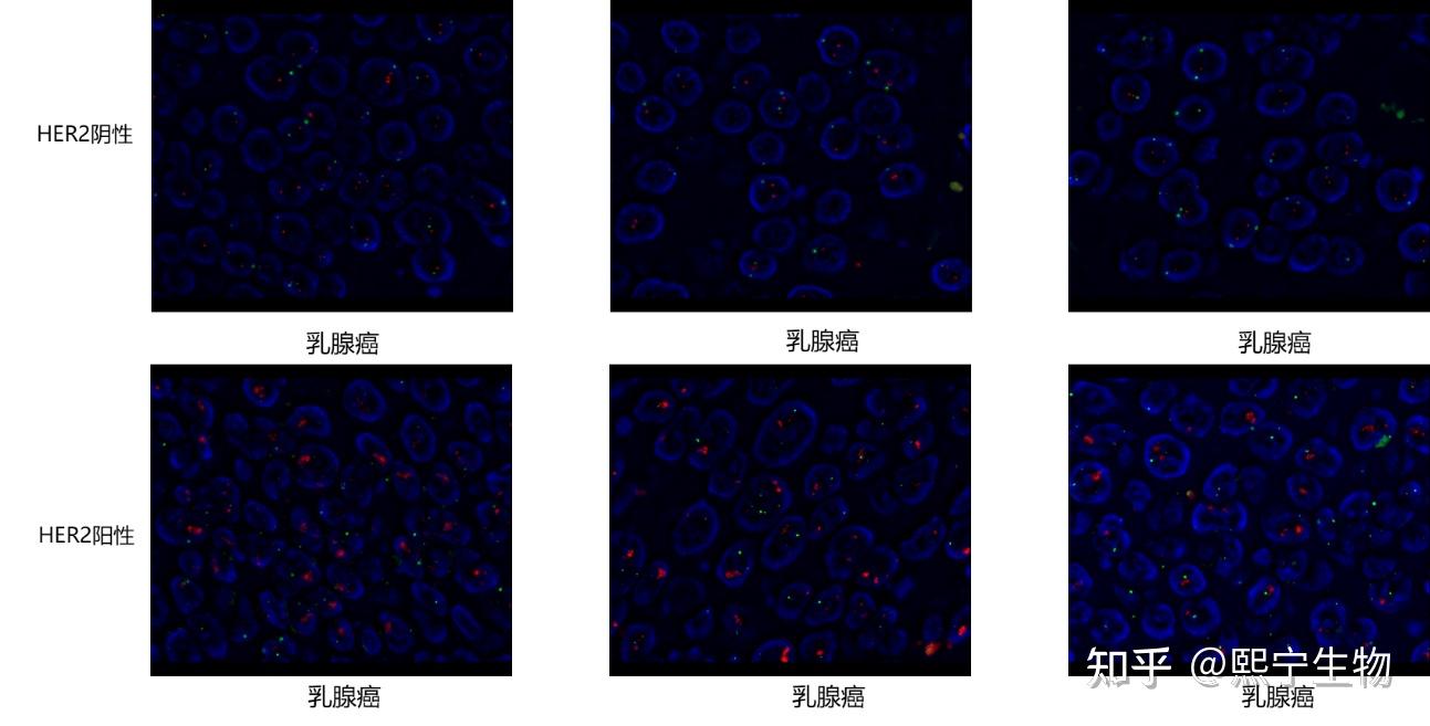 精准治疗的钥匙（二）：揭秘HER2基因扩增/蛋白过表达 - 知乎