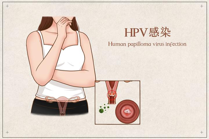 HPV 疫苗是什么？到底该不该接种？ - 知乎