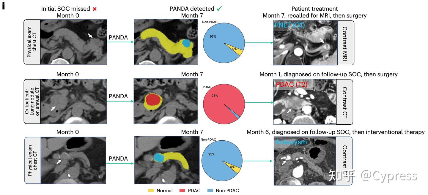 Large-scale pancreatic cancer detection via non-contrast CT and deep ...