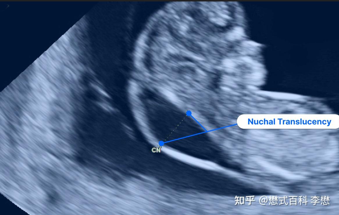 NT 检查的时间是什么时候？ - 知乎