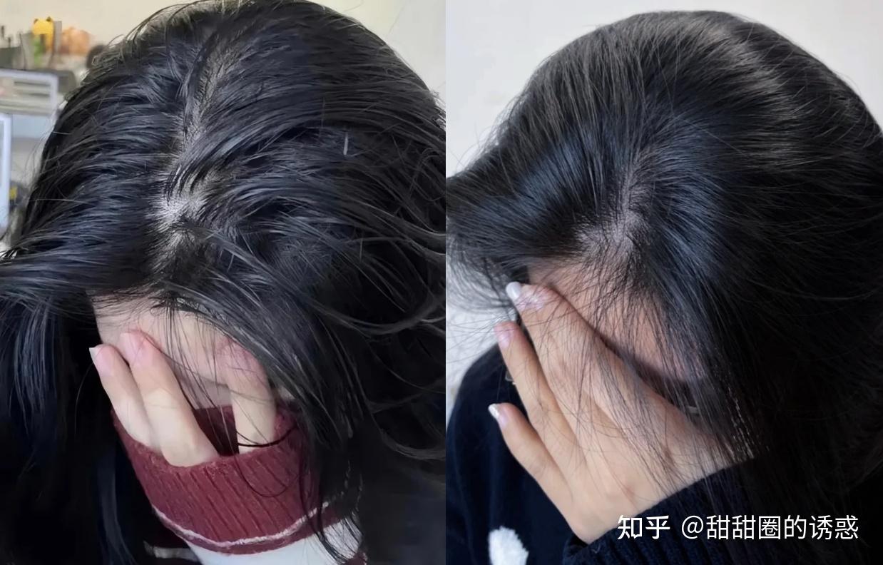 看到很多人都在推哈恩咖啡因洗发水，想问它真的那么好用吗？想要头发清爽、干净、不长头屑用哈恩咖啡因洗发水可以吗？ - 知乎