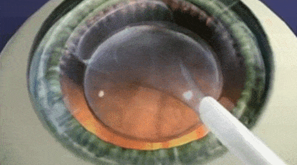 ICL晶体植入安全吗？莆田眼科为您解答 - 知乎