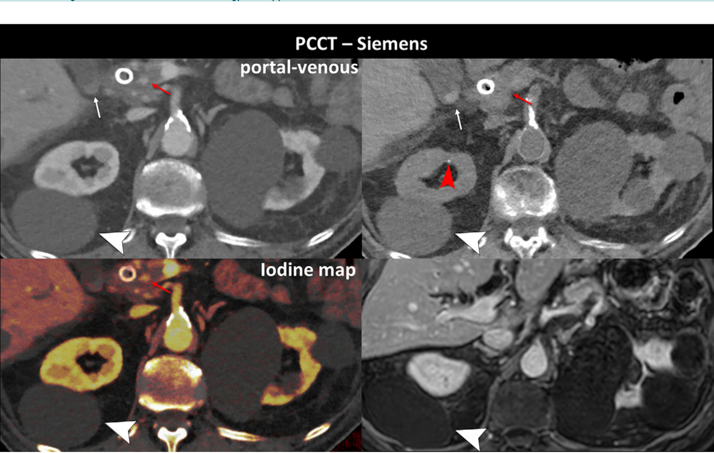 CT技术革命？一文读懂光子计数CT（PCCT）的前沿进展与临床潜力 - 知乎