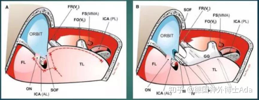 世界神外大师Dolenc教授：Dolenc三角、Dolenc手术入路简述 - 知乎
