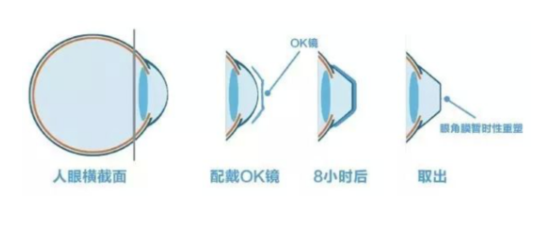 硬性隐形眼镜（RGP）好吗？ - 知乎