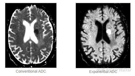 MRI ADC值是怎么来的？咱们来手算一下 - 知乎