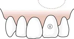 种植牙口外术式小百科—Partsch C. 切⼝術 - 知乎